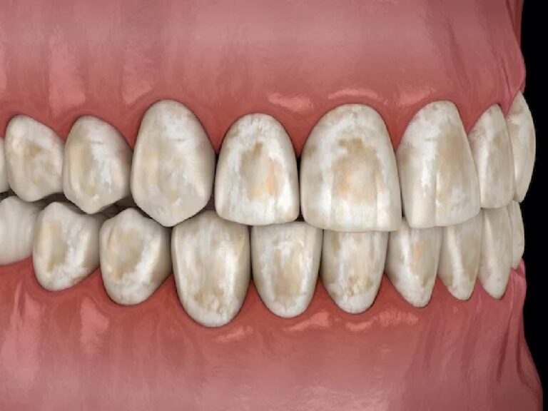 ICON Resin Infiltration - Majidian Dental - Fargo, ND